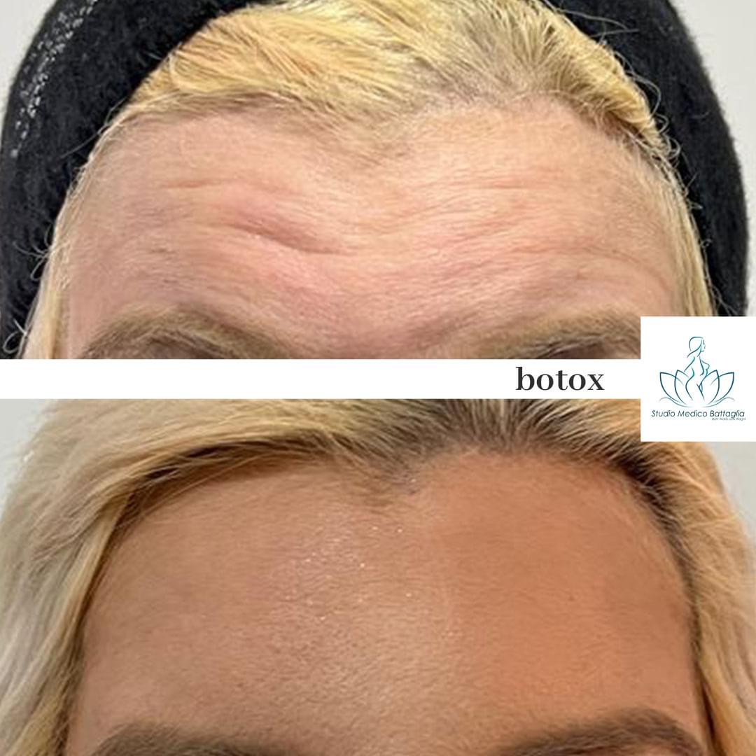 Botox e meso botox – Medicina Estetica Battaglia